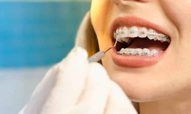 Fast Braces: Discover If They're Right For You