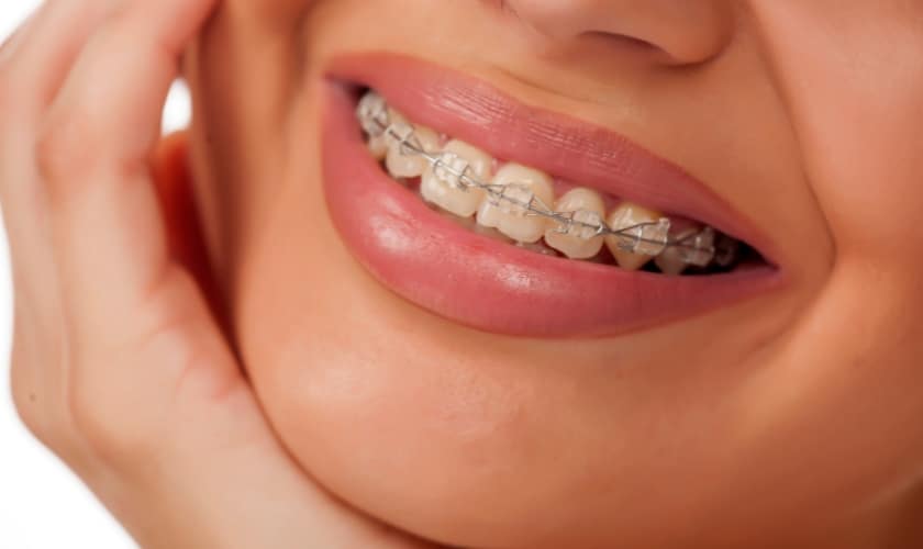 Fast Braces Demystified: A Swift Path to Your Perfect Smile