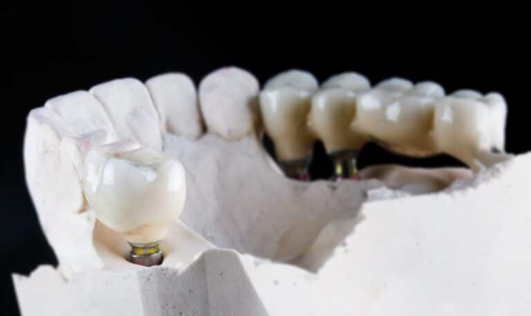 Dental Bridge Fell Out? Here's What To Do