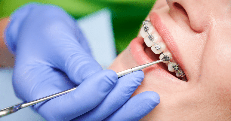 Fast Braces: Do They Really Work Faster? The Science Behind It